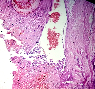 Mola invasiva. Presentación de un caso | Sanamé-Columbié | Revista ...